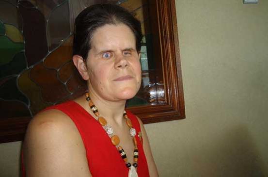 Experts: Genetics the greatest cause of eye cell deformation - The ...